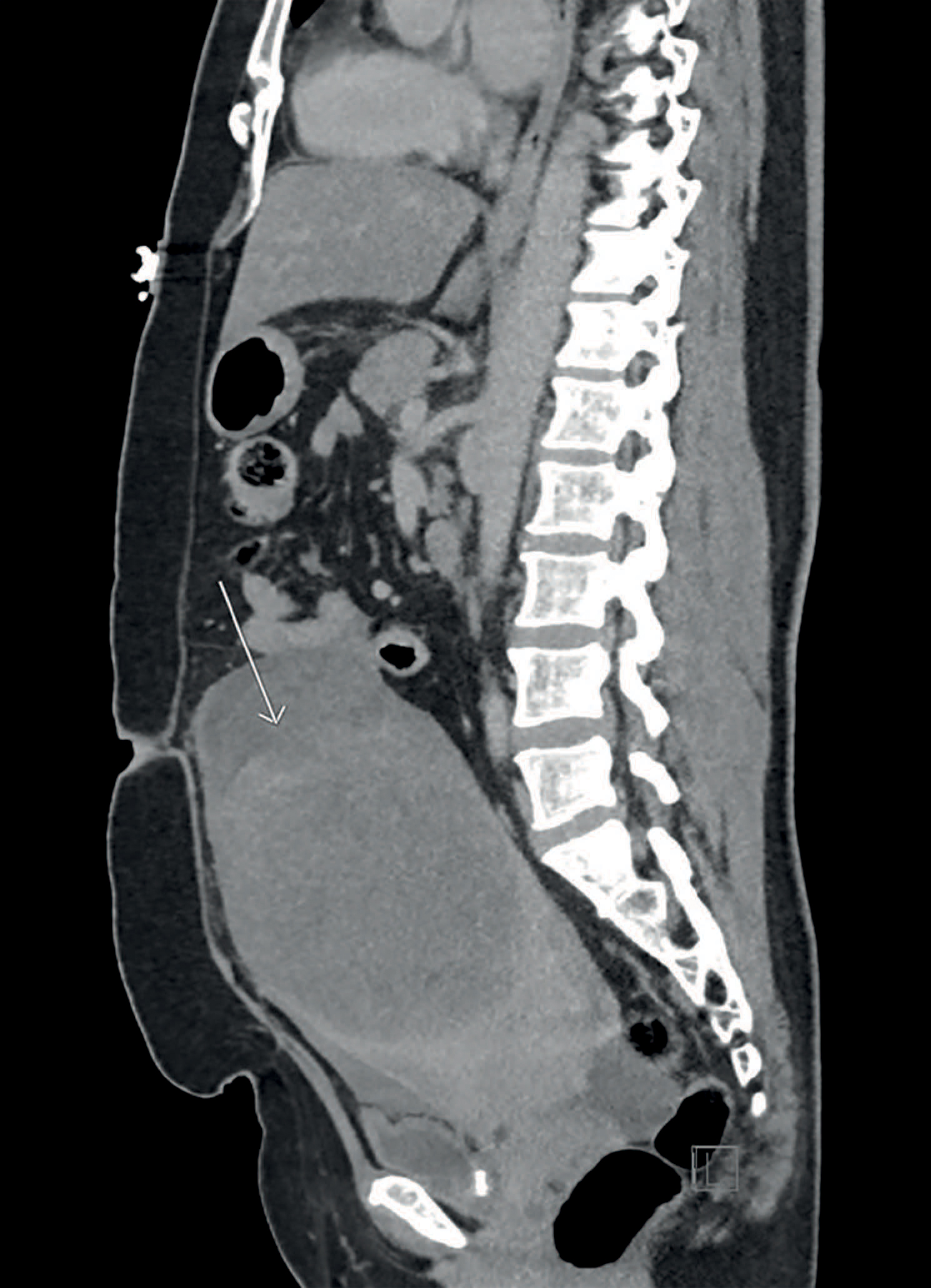 Fibroid uterus: an unusual cause of intraperitoneal haemorrhage – O&G ...
