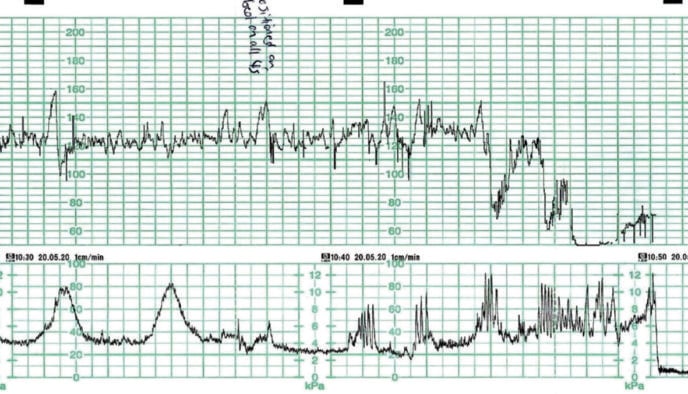The fetal bradycardia – O&G Magazine