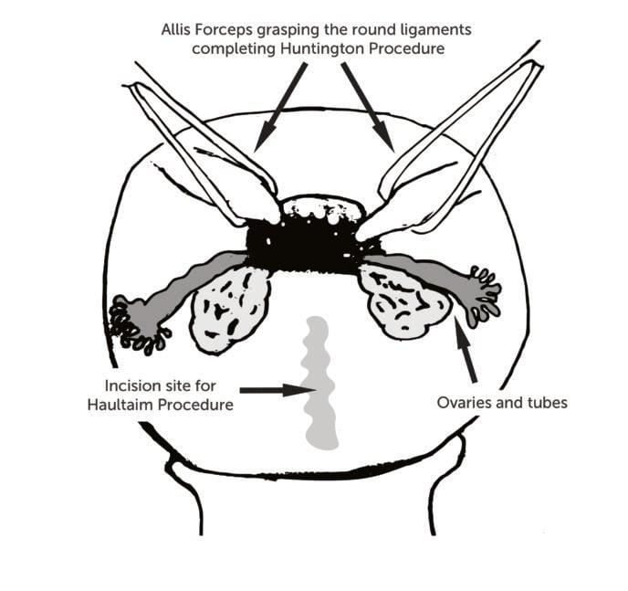 Uterine Inversion Oandg Magazine