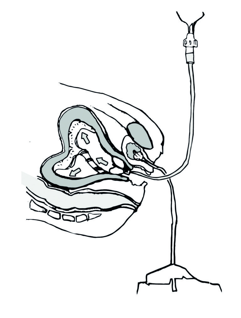 Uterine inversion – O&G Magazine