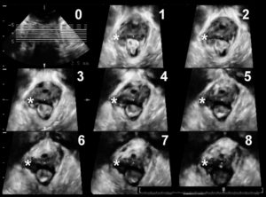 Pelvic floor trauma in childbirth – O&G Magazine