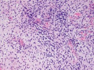 Just a cervical polyp? A rare and interesting diagnosis – O&G Magazine