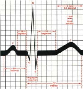 The fetal ECG ST waveform – O&G Magazine
