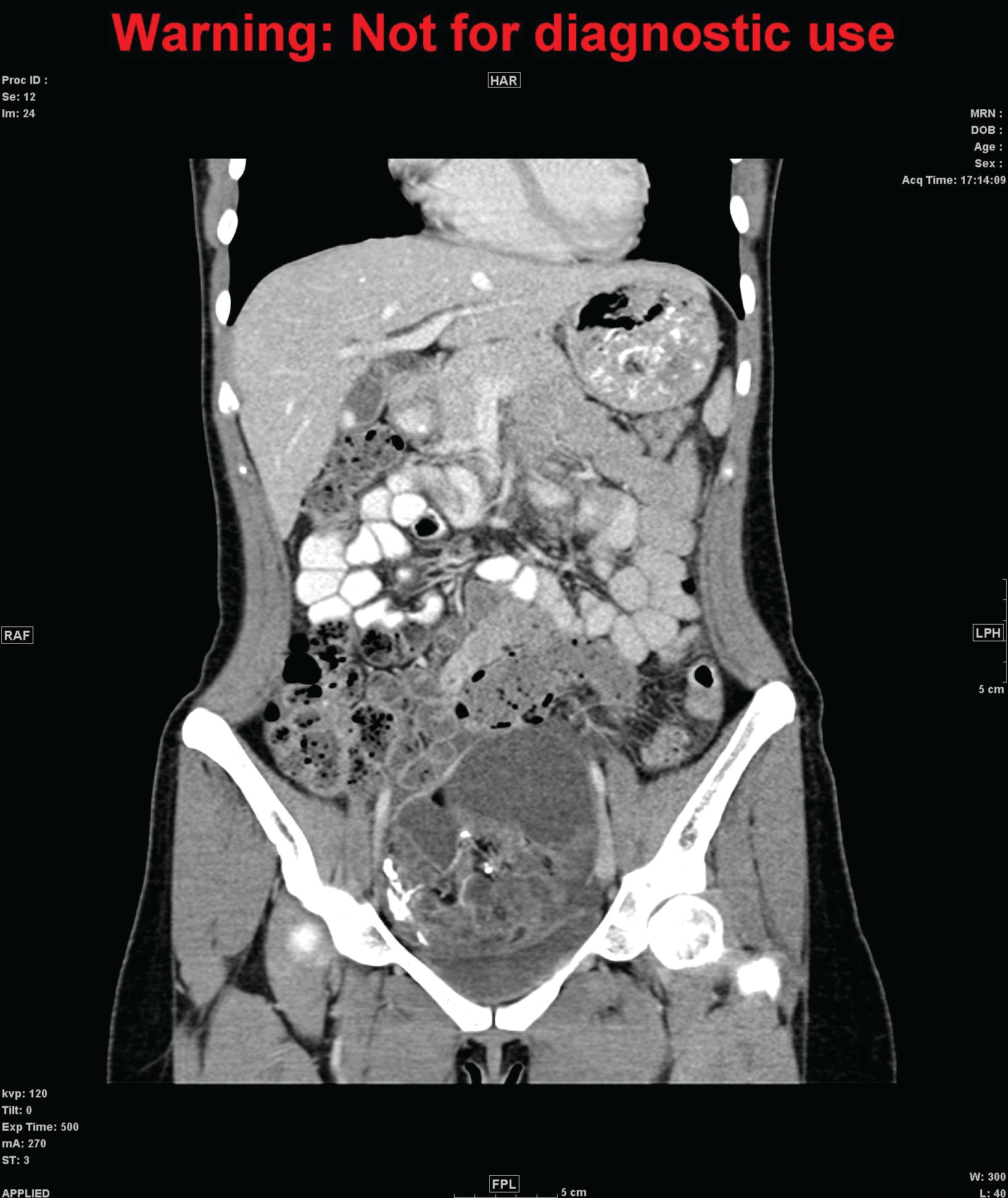 Ovarian Teratoma Dermoid Cyst And Encephalitis A Link What Is An