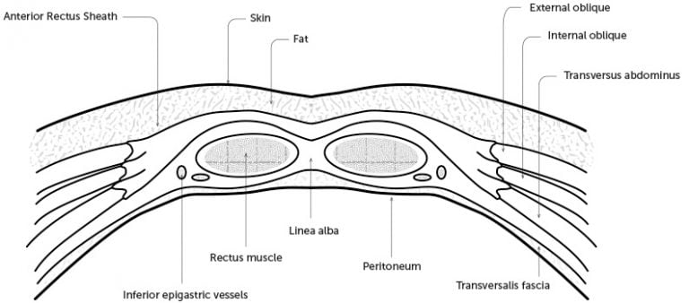 The Maylard incision: Setthathirath technique – O&G Magazine
