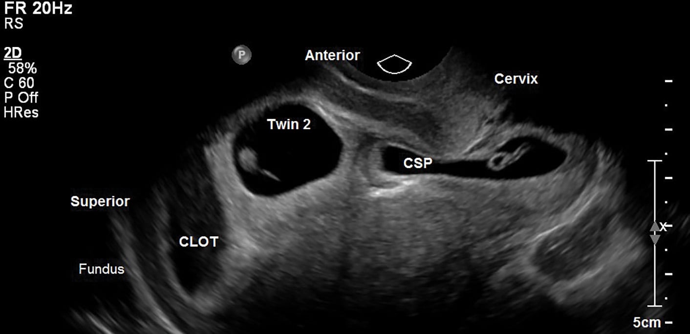 Heterotopic Caesarean Section Scar Ectopic Oandg Magazine