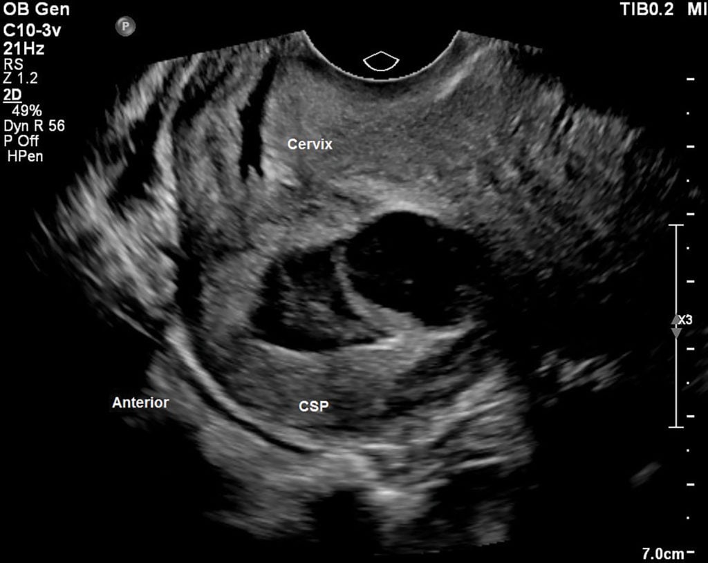 Heterotopic Caesarean Section Scar Ectopic Oandg Magazine