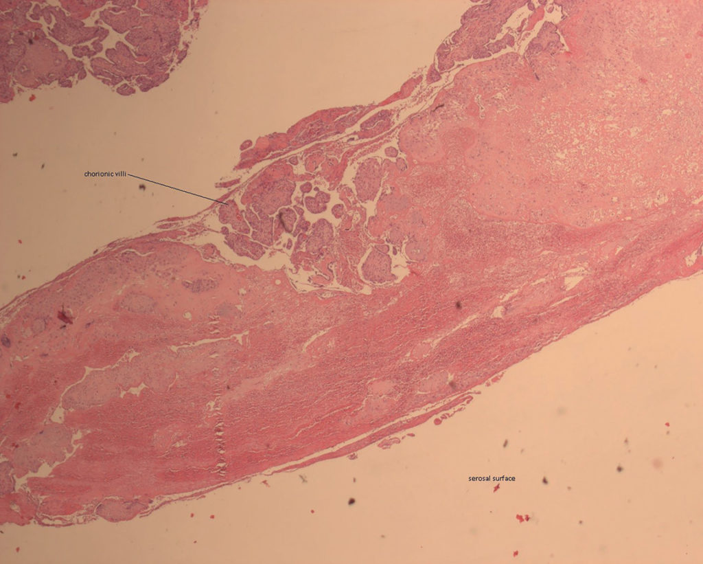 Uterine rupture secondary to placenta percreta – O&G Magazine