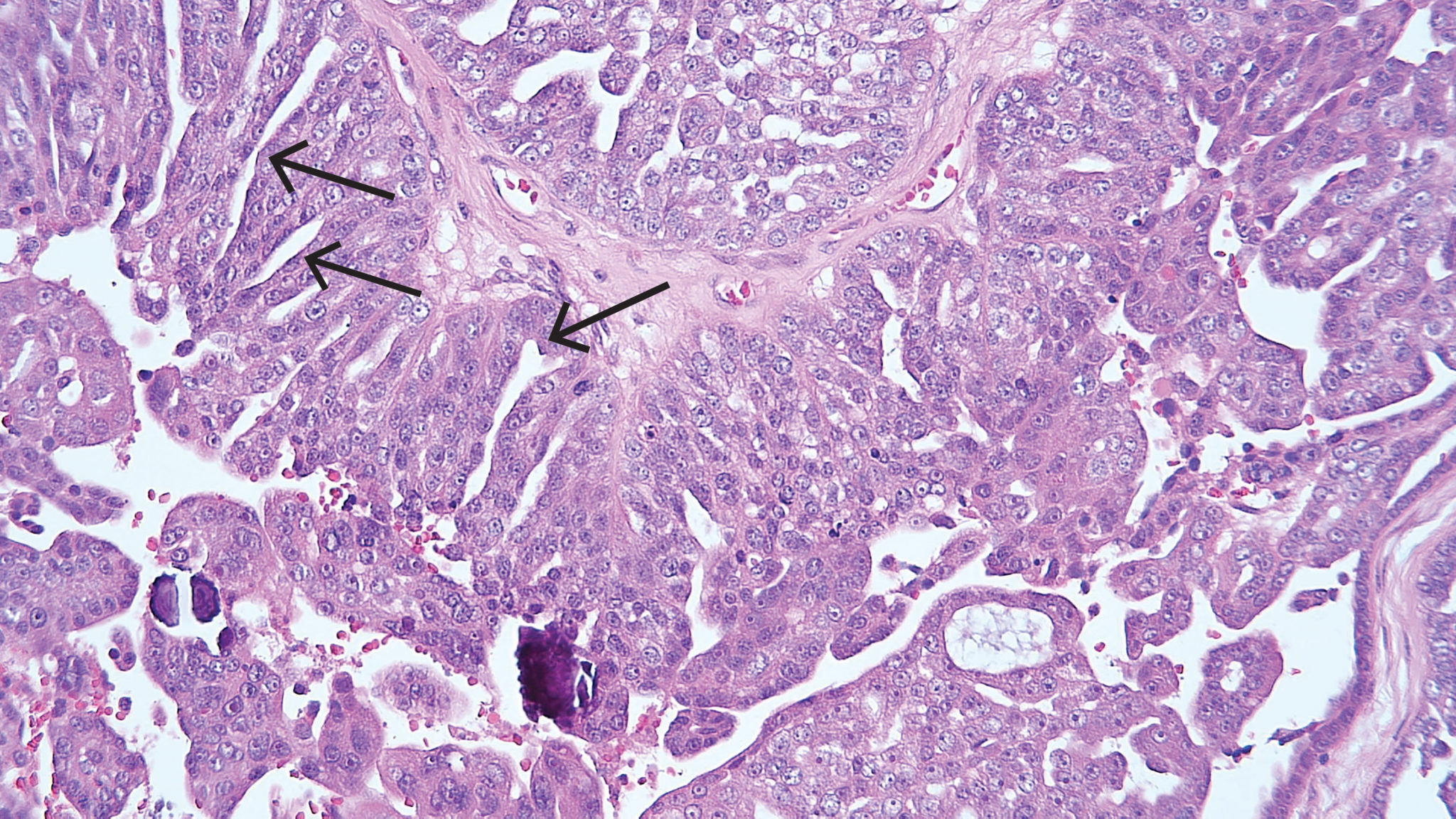 Tumour pathology and classification – O&G Magazine