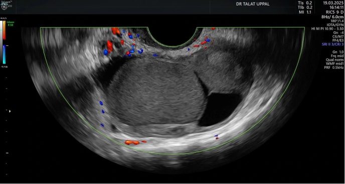 Ultrasound in Endometriosis: Advancing Non-Invasive Diagnosis and ...