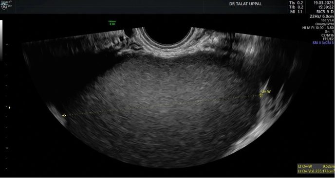 Ultrasound in Endometriosis: Advancing Non-Invasive Diagnosis and ...